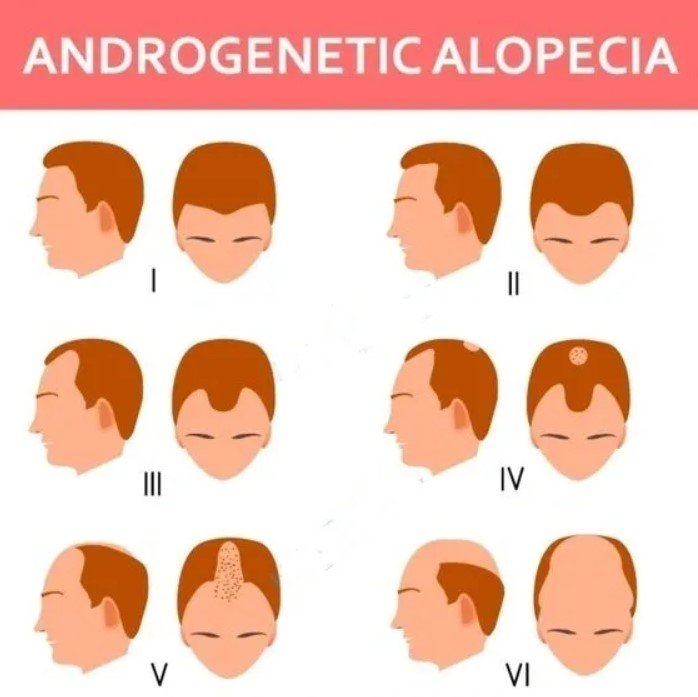 Androgenetic Alopecia - Best Hair Transplant Clinic In Delhi | HFHG ...